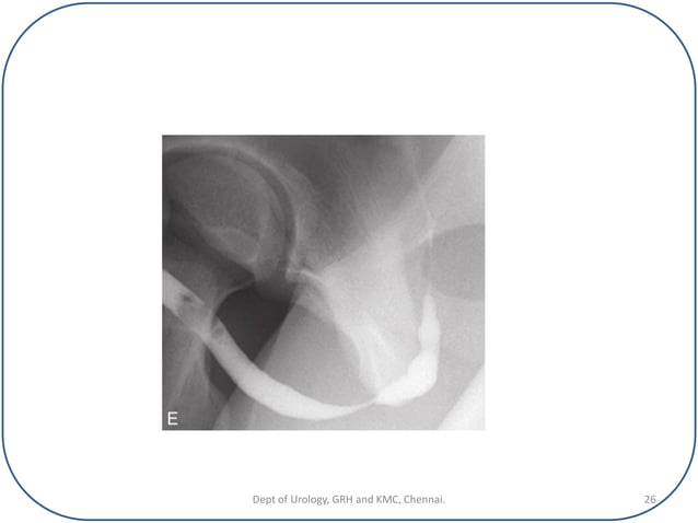 VOIDING CYSTO URETHROGRAM | PDF