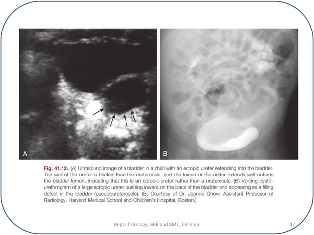 VOIDING CYSTO URETHROGRAM | PDF