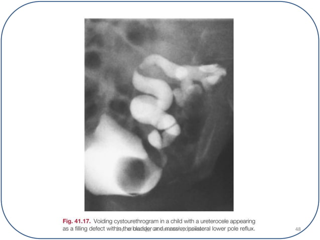 VOIDING CYSTO URETHROGRAM | PDF