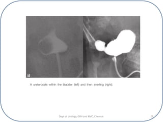 Posterior Urethral Valves Vcug
