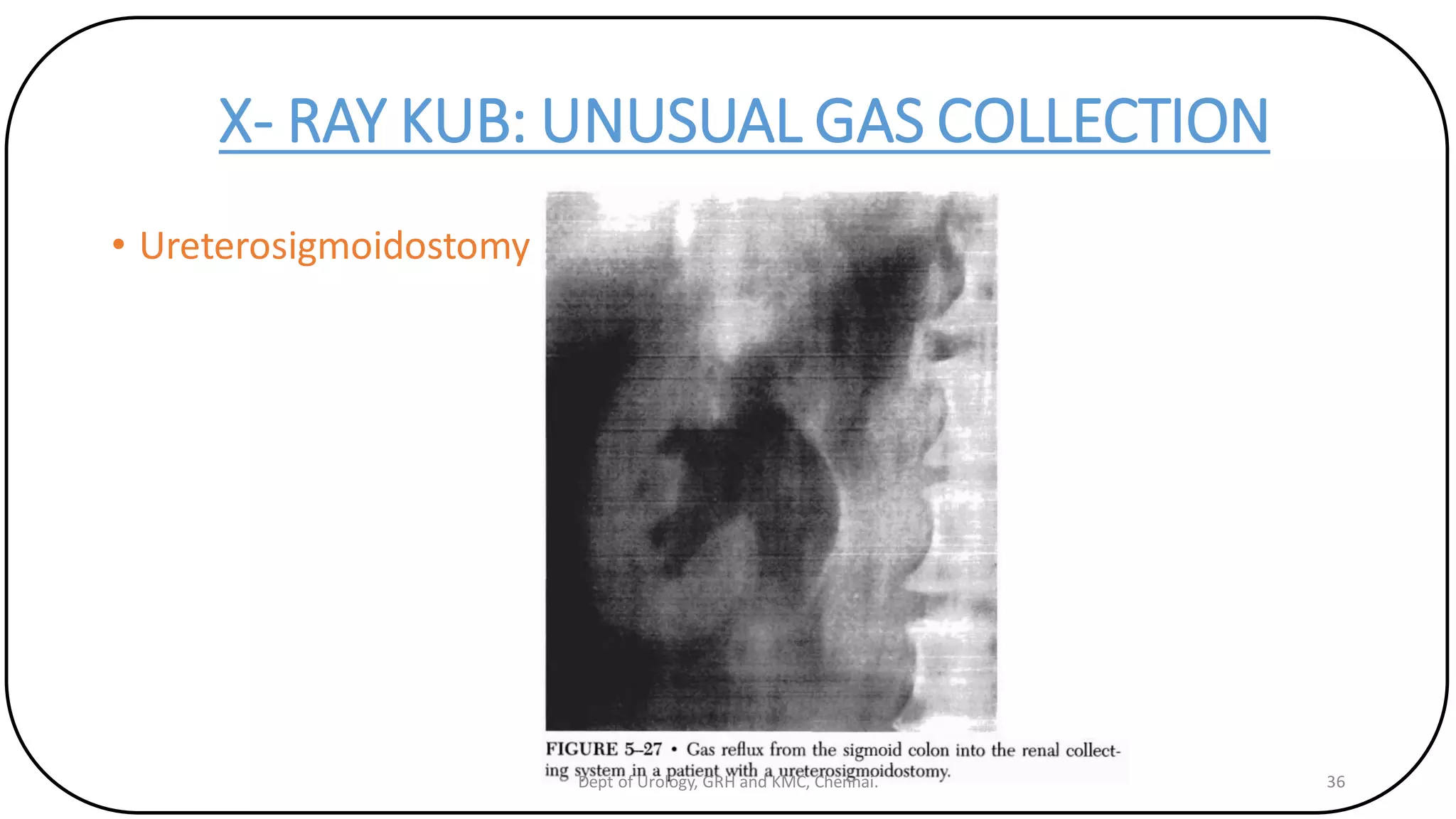 X RAY KUB 2 | PDF