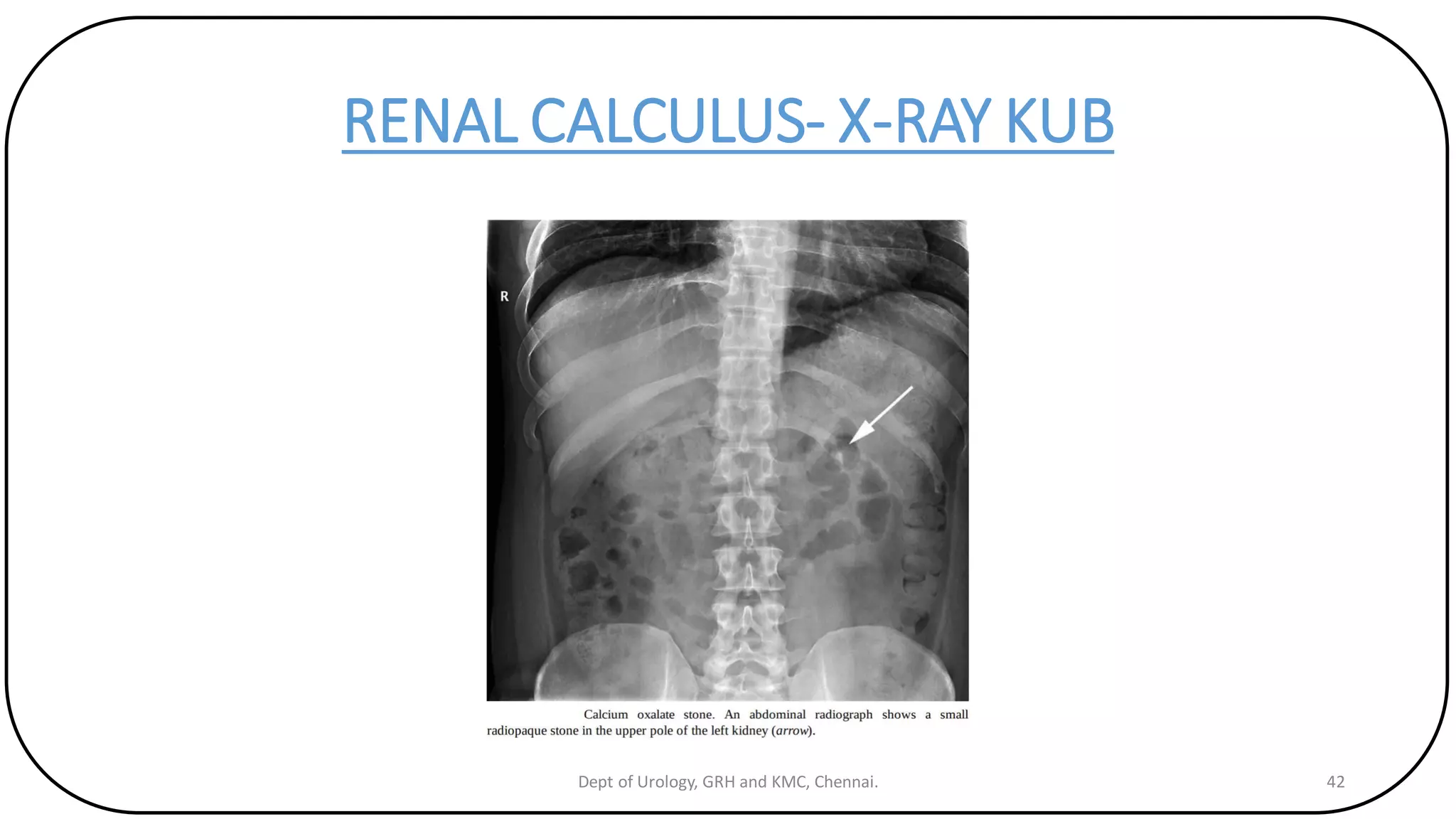 X RAY KUB 2 | PDF