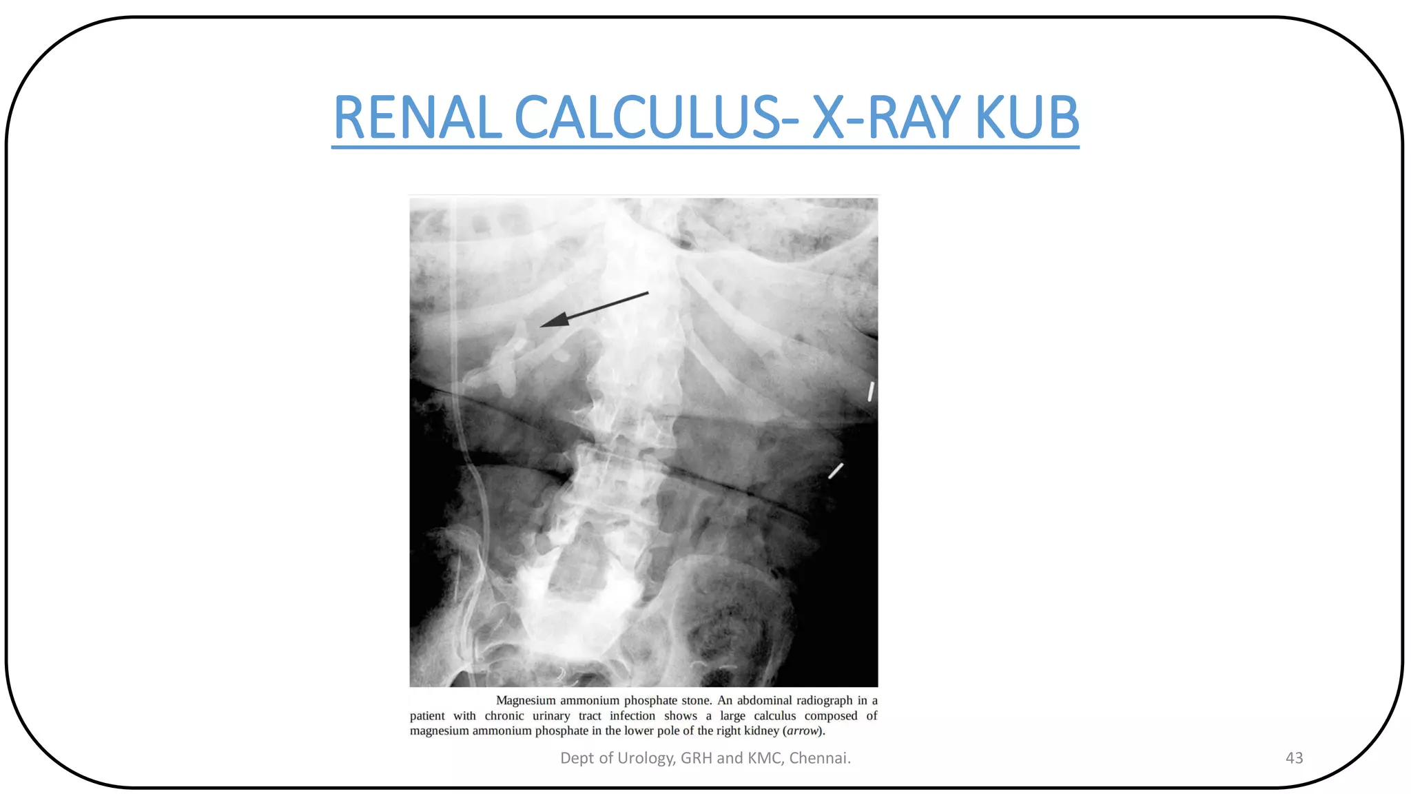X RAY KUB 2 | PDF