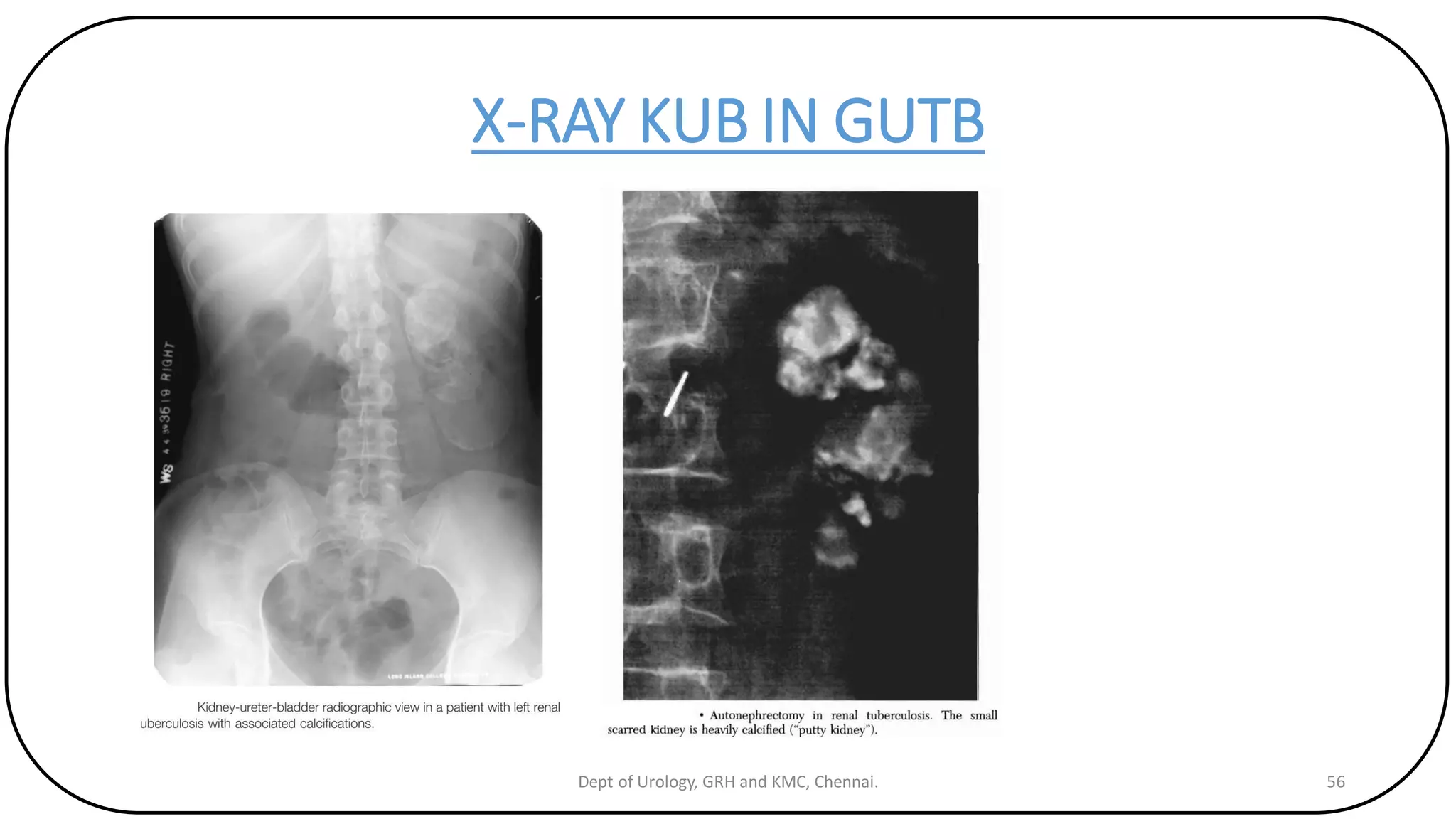 X RAY KUB 2 | PDF