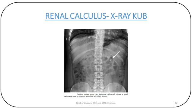 X RAY KUB 2 | PDF
