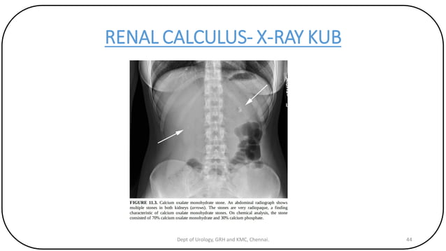 X RAY KUB 2 | PDF