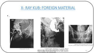 X RAY KUB 2 | PDF