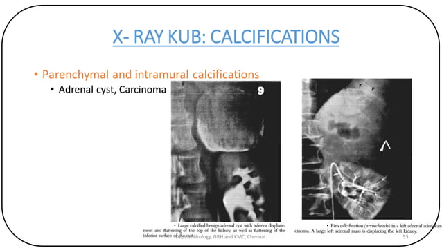 X RAY KUB 2