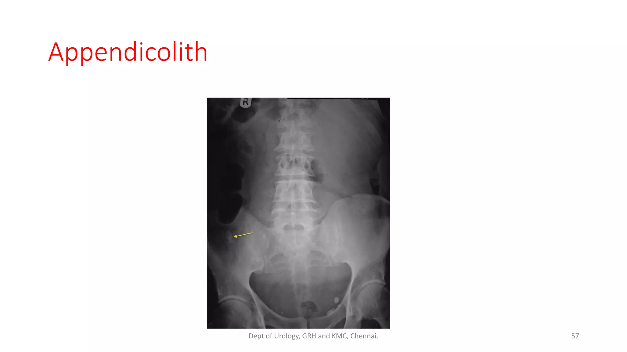 X RAY KUB 1 | PDF
