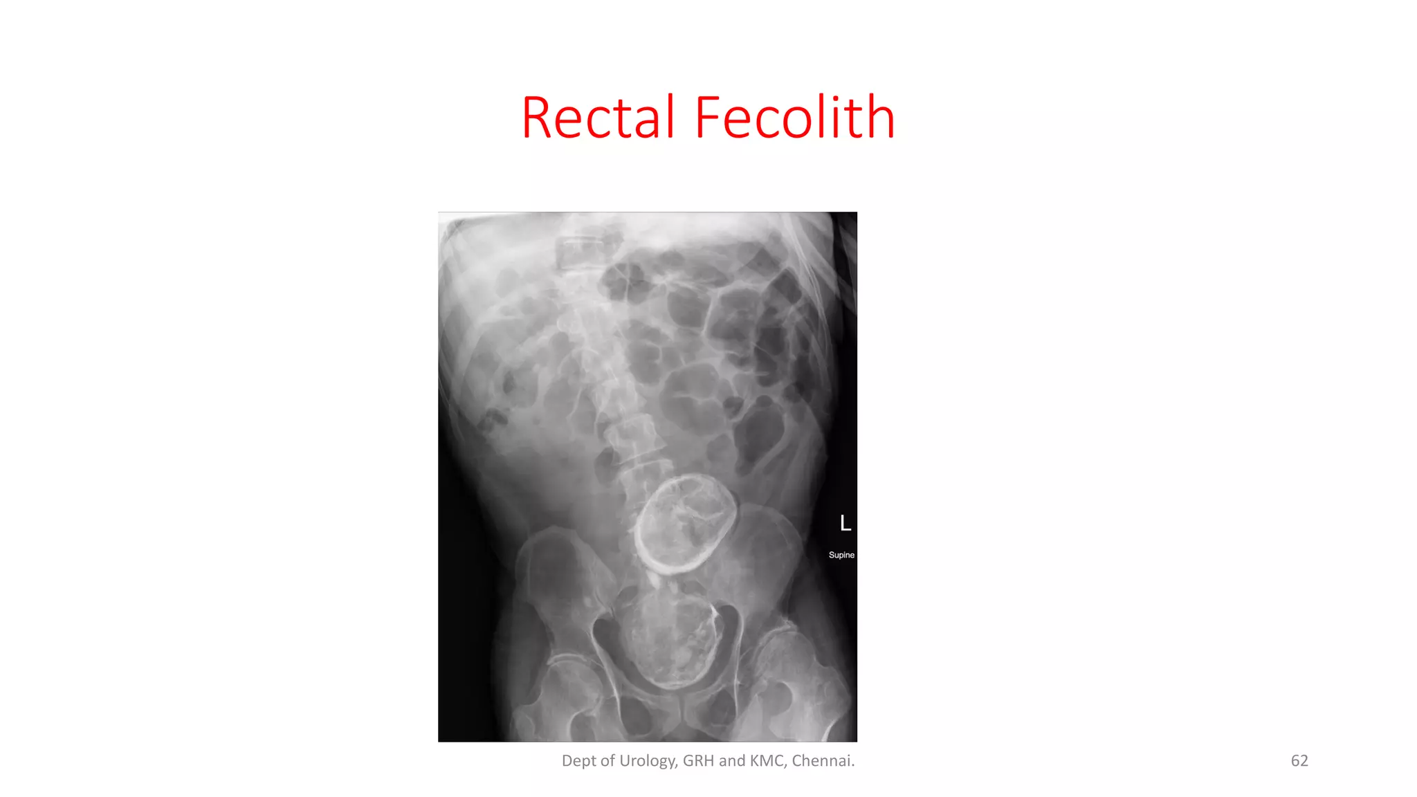 X RAY KUB 1 | PDF