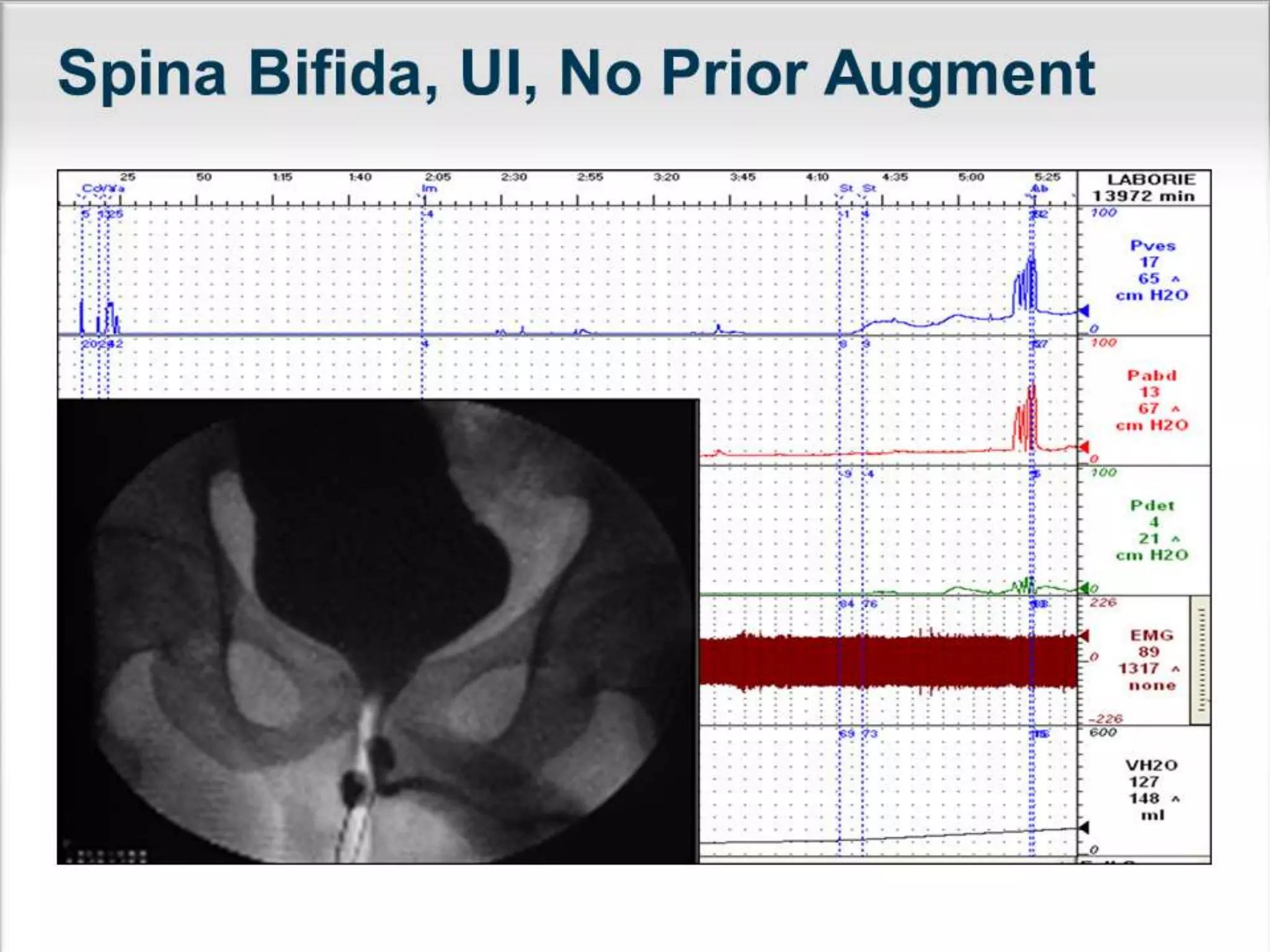 Urodynamic studies for neurogenic bladder | PDF