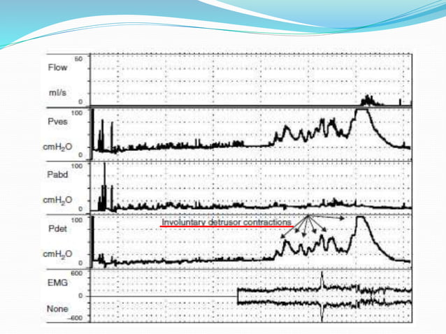 Urodynamic study | PPT