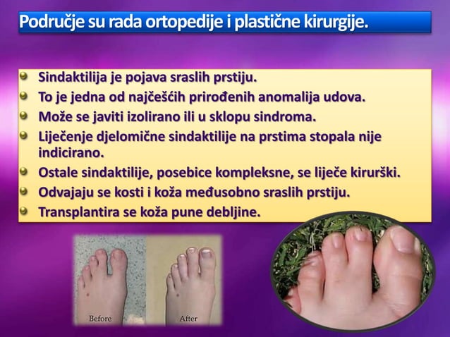 Urođene anomalije donjih udova | PPSX