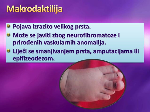 Urođene anomalije donjih udova | PPSX