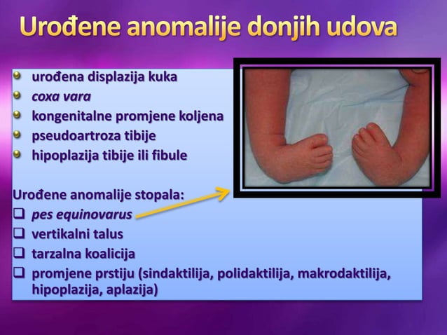 Urođene anomalije donjih udova | PPSX
