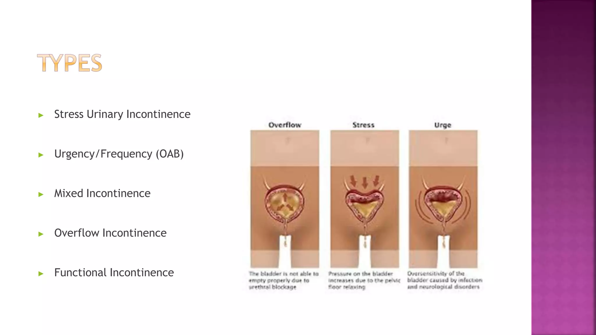 Urogenital prolapse and urinary incontinence 22.04.2021
