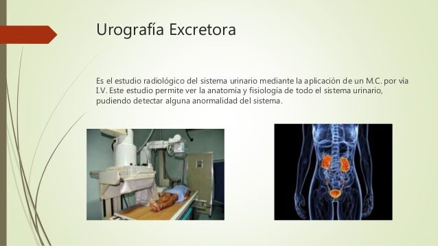 Urografía excretora