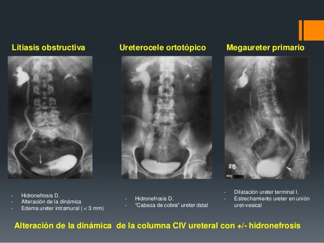 Urografía IV- TC Urografía. Técnica e indicaciones.