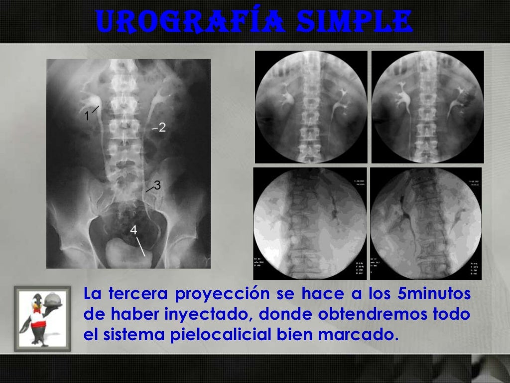 Urografia excretora