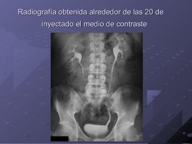 Urograma excretor-3°