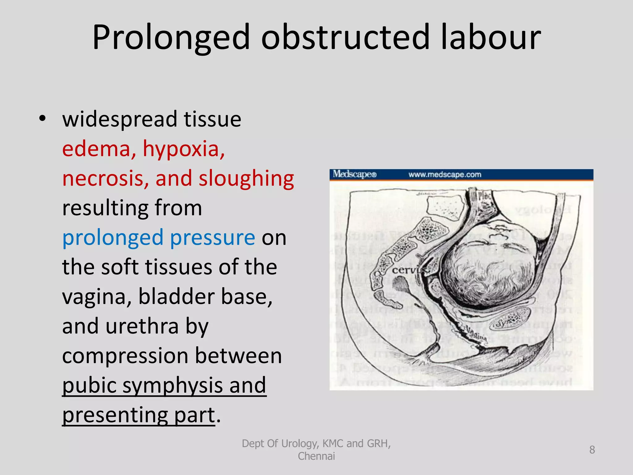 Urogynacology fistulae overview | PPT