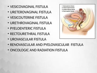 uro gynecologic fistulas in lower urinary tract | PPTX