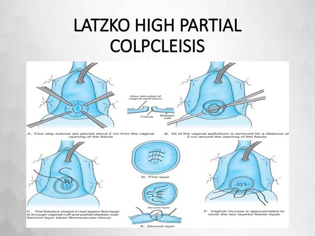 uro gynecologic fistulas in lower urinary tract | PPTX