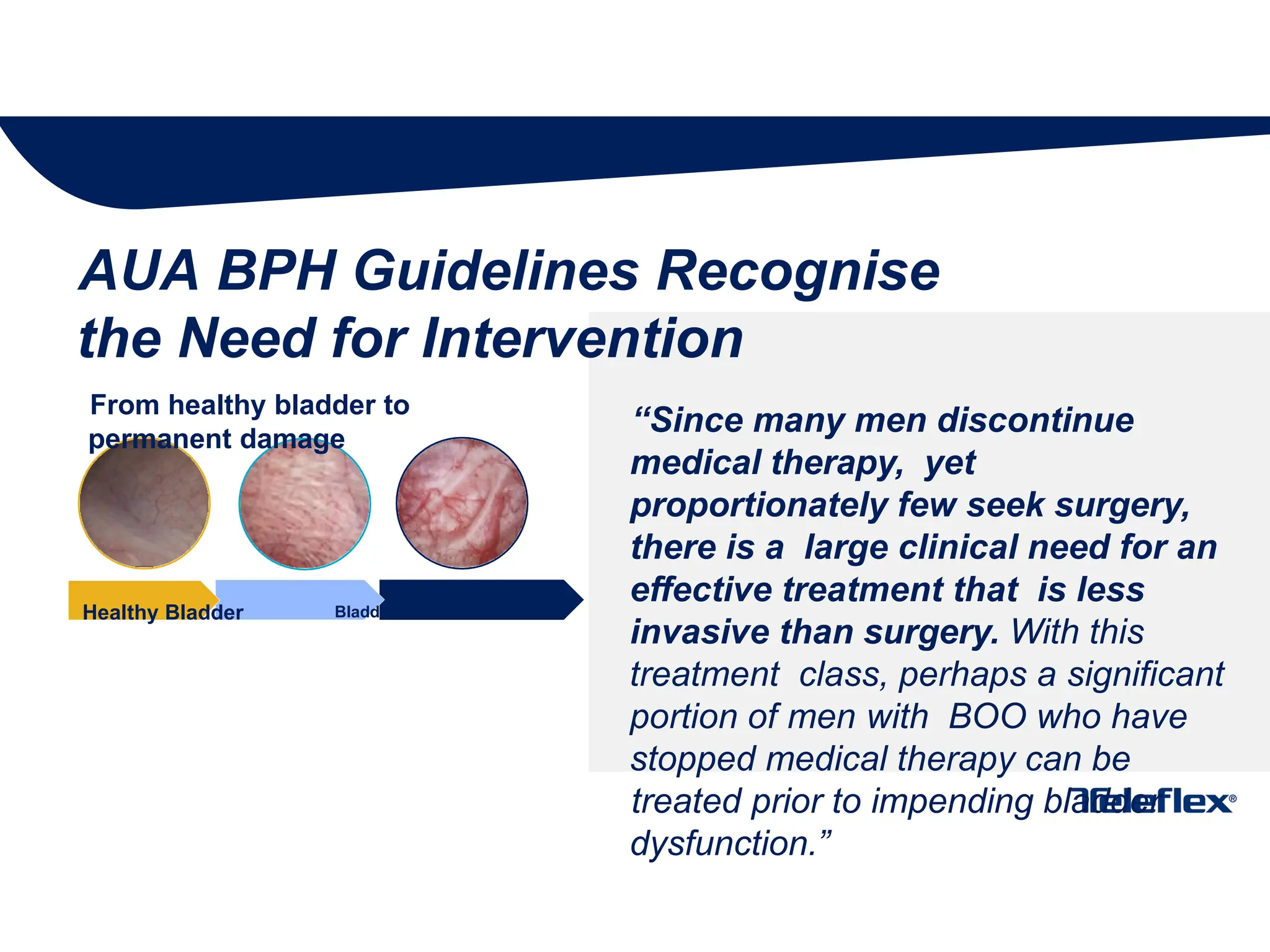 urolift ppt , Minimally invasive treatment for prostate enlargement.pptx