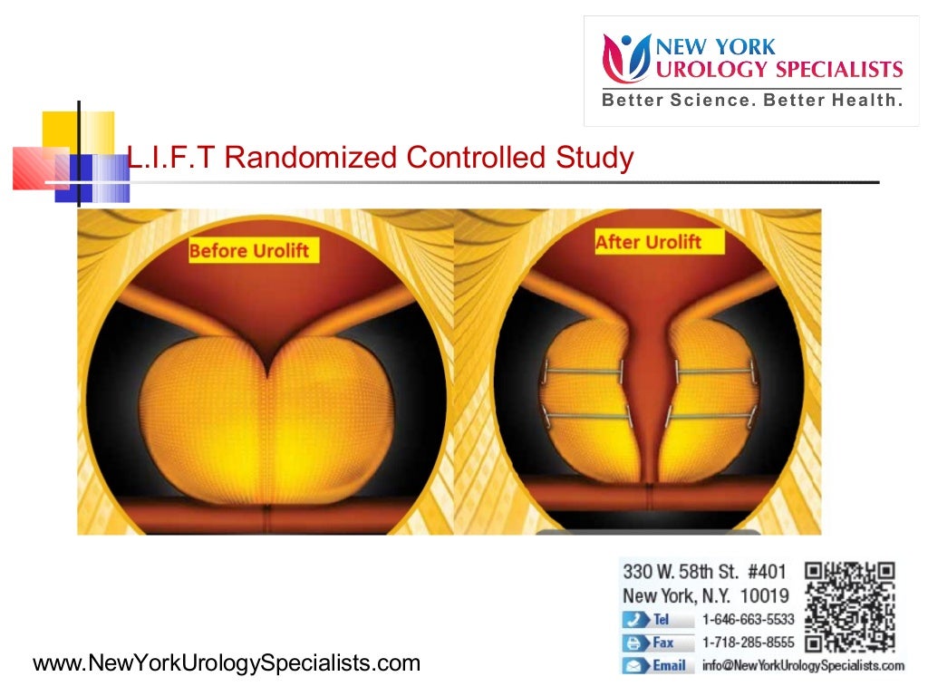 Urolift System for Treatment BPH and Enlarged Prostate