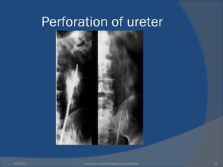 Urolithiasis -Modern Management | PPT