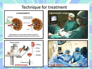 Urolithiasis | PPTX