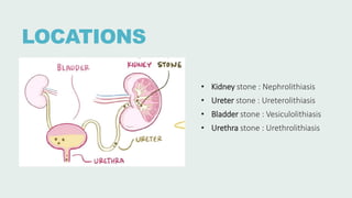 UROLITHIASIS.pptx | Digestive Disorders | Diseases and Conditions