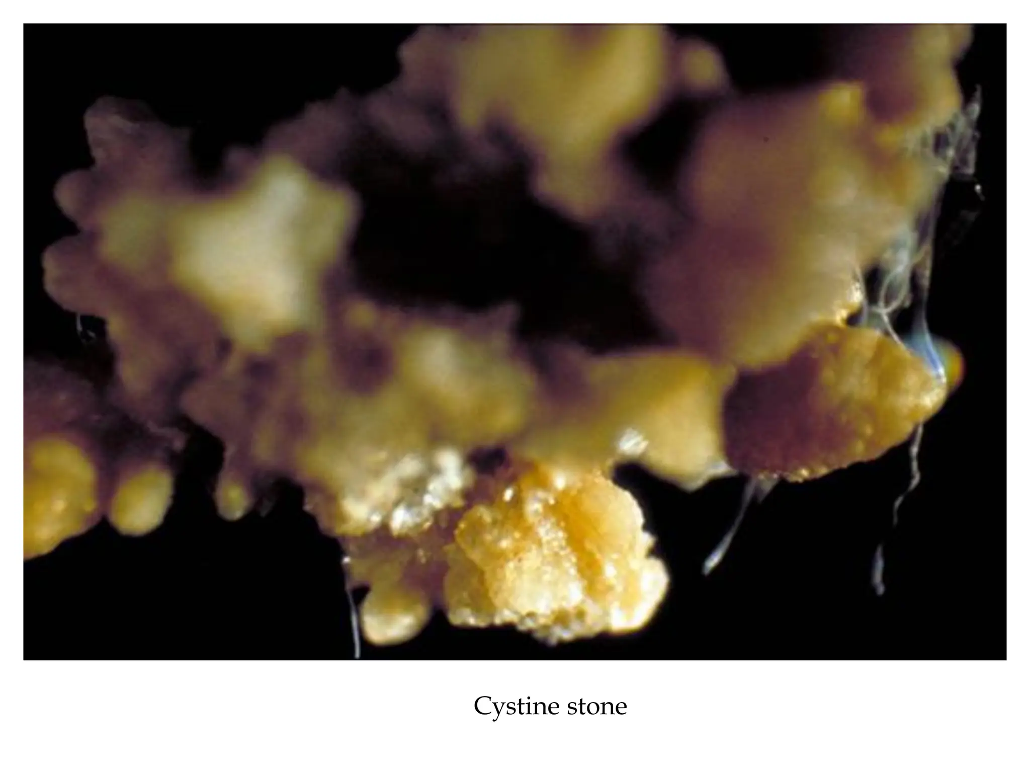 Urolithiasis. Medical surgical nursing pdf | PDF