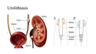 Urolithiasis ( Kidney Stones) For ClinicalMedicine.pptx