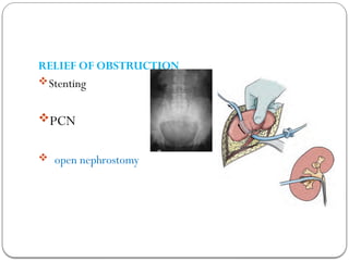 Urolithiasis topics of surgery .....pptx