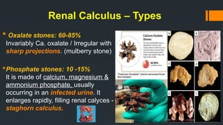 Urolithiasis - Stones of the Urinary System | PPTX
