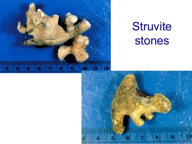 Struvite Kidney Stones Soft