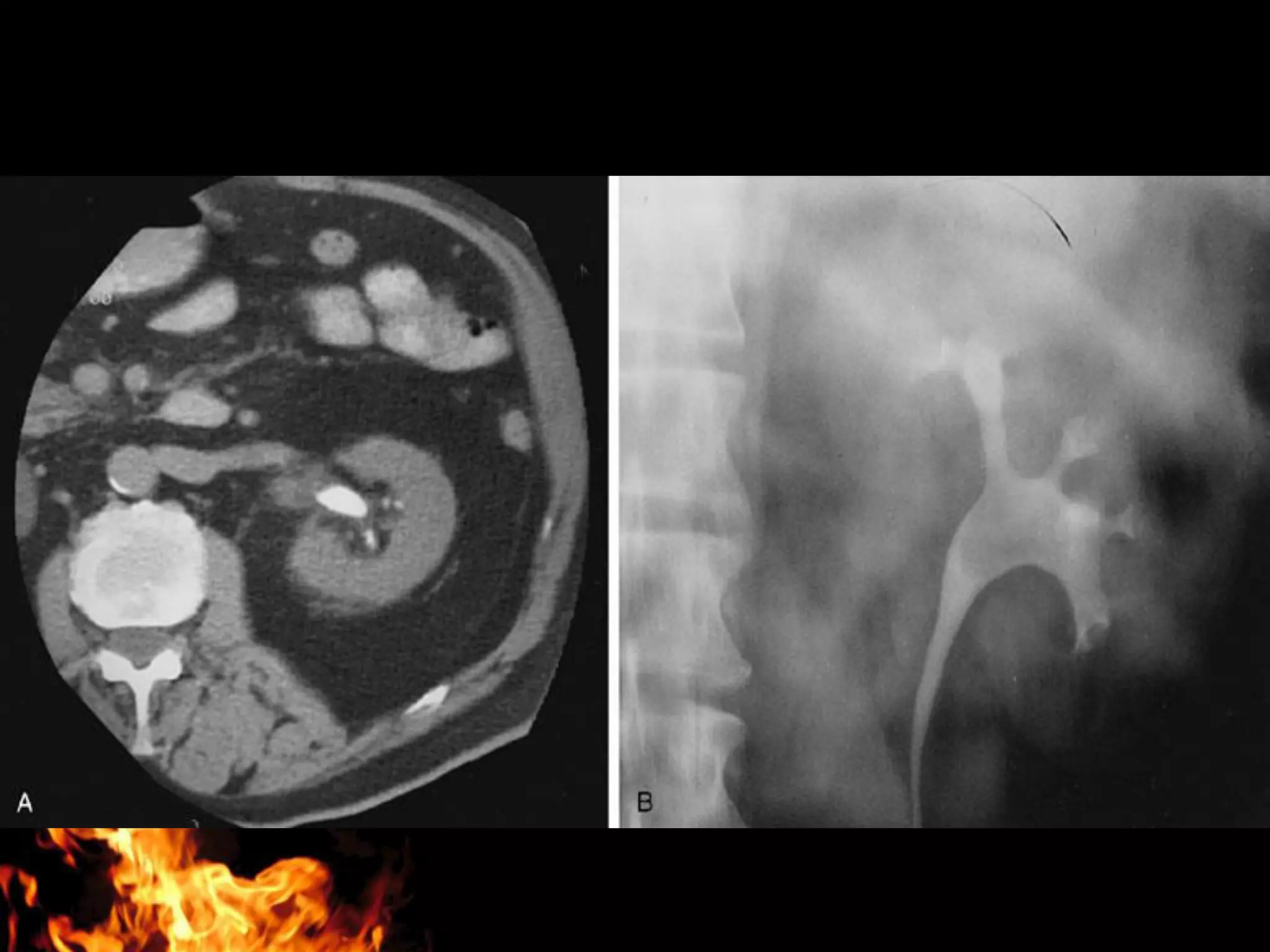 Urolithiasis evaluation and management brief | PDF