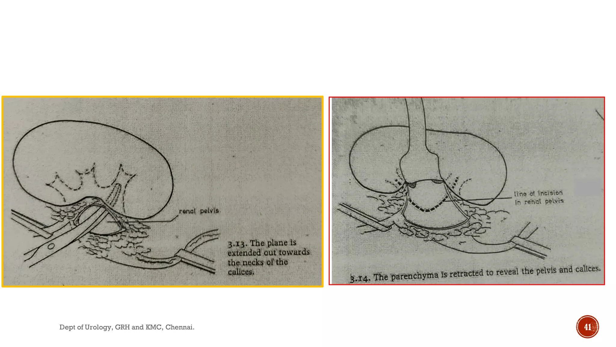 Urolithiasis management- surgical open | PDF