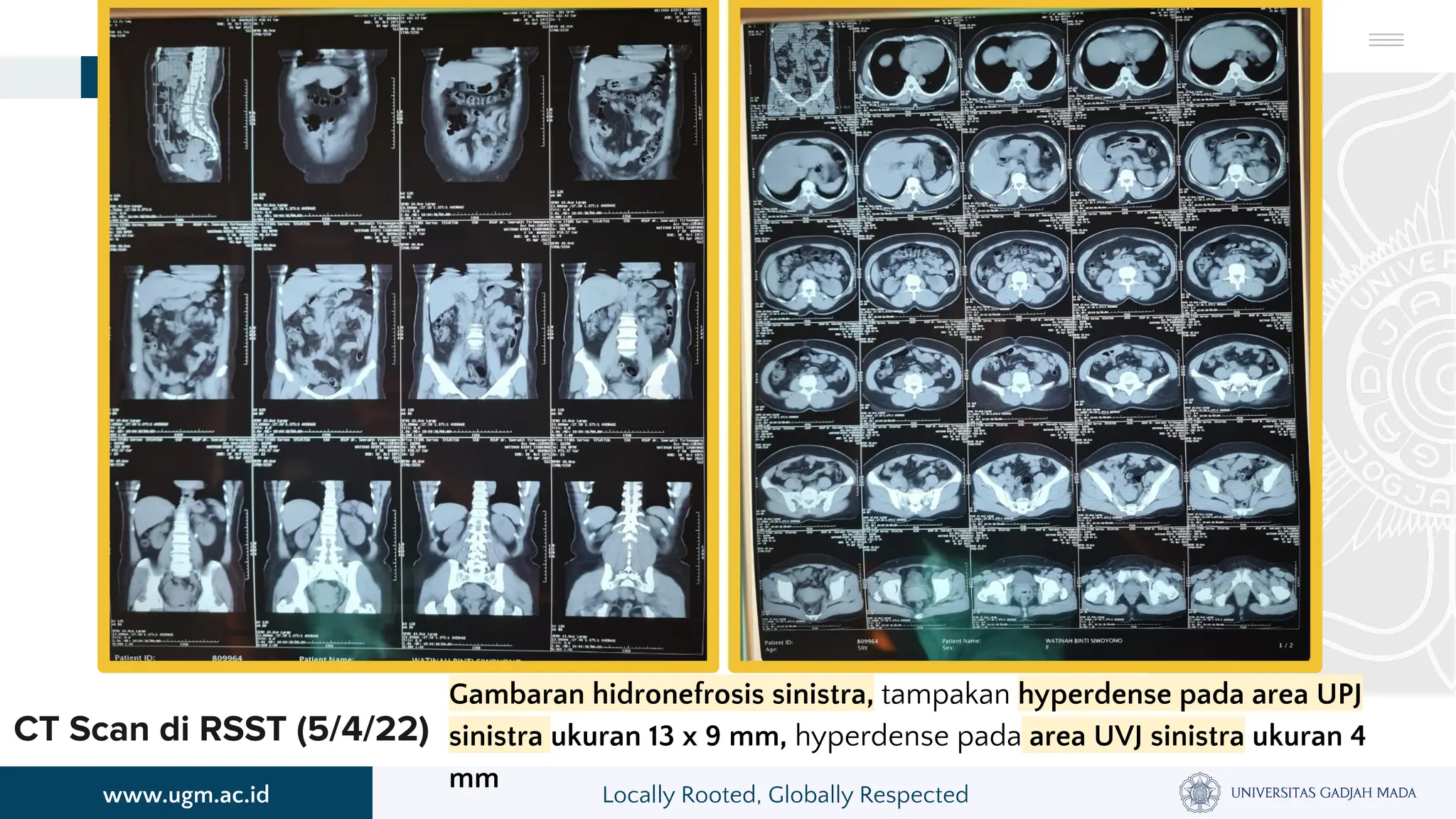 Urolithiasis - Presentasi Urologi RSST.pdf
