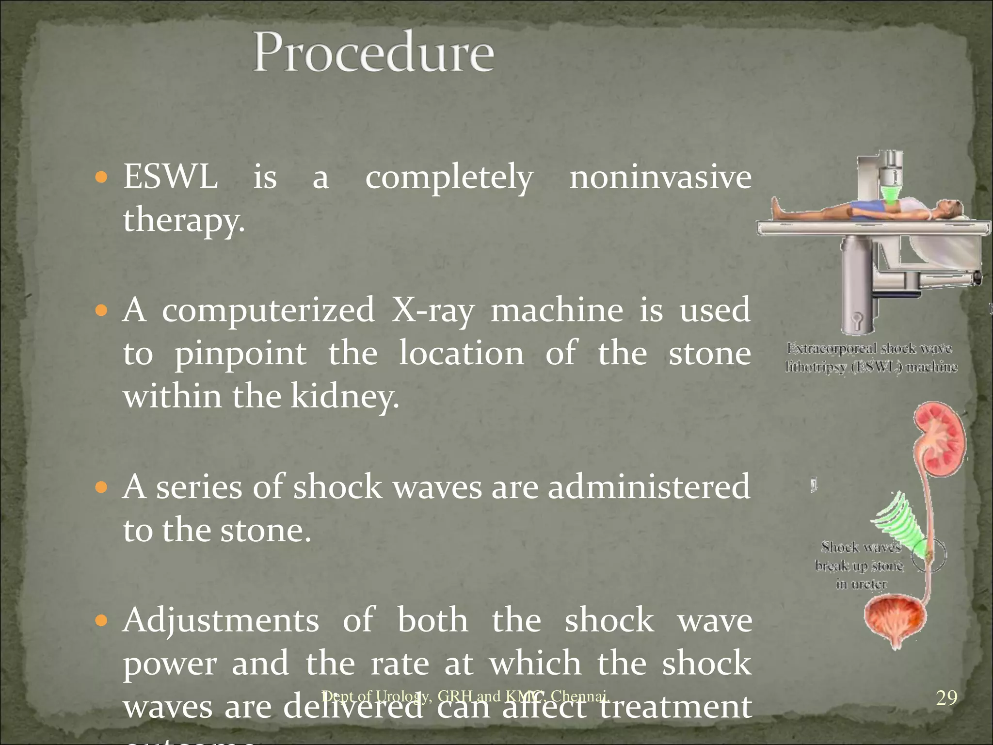 Urolithiasis: Renal calculi rsd | PPT