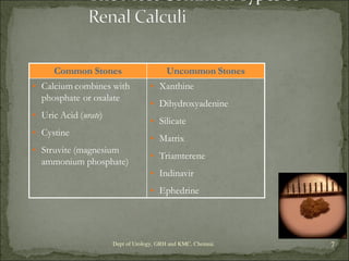 Urolithiasis: Renal calculi rsd | PPT