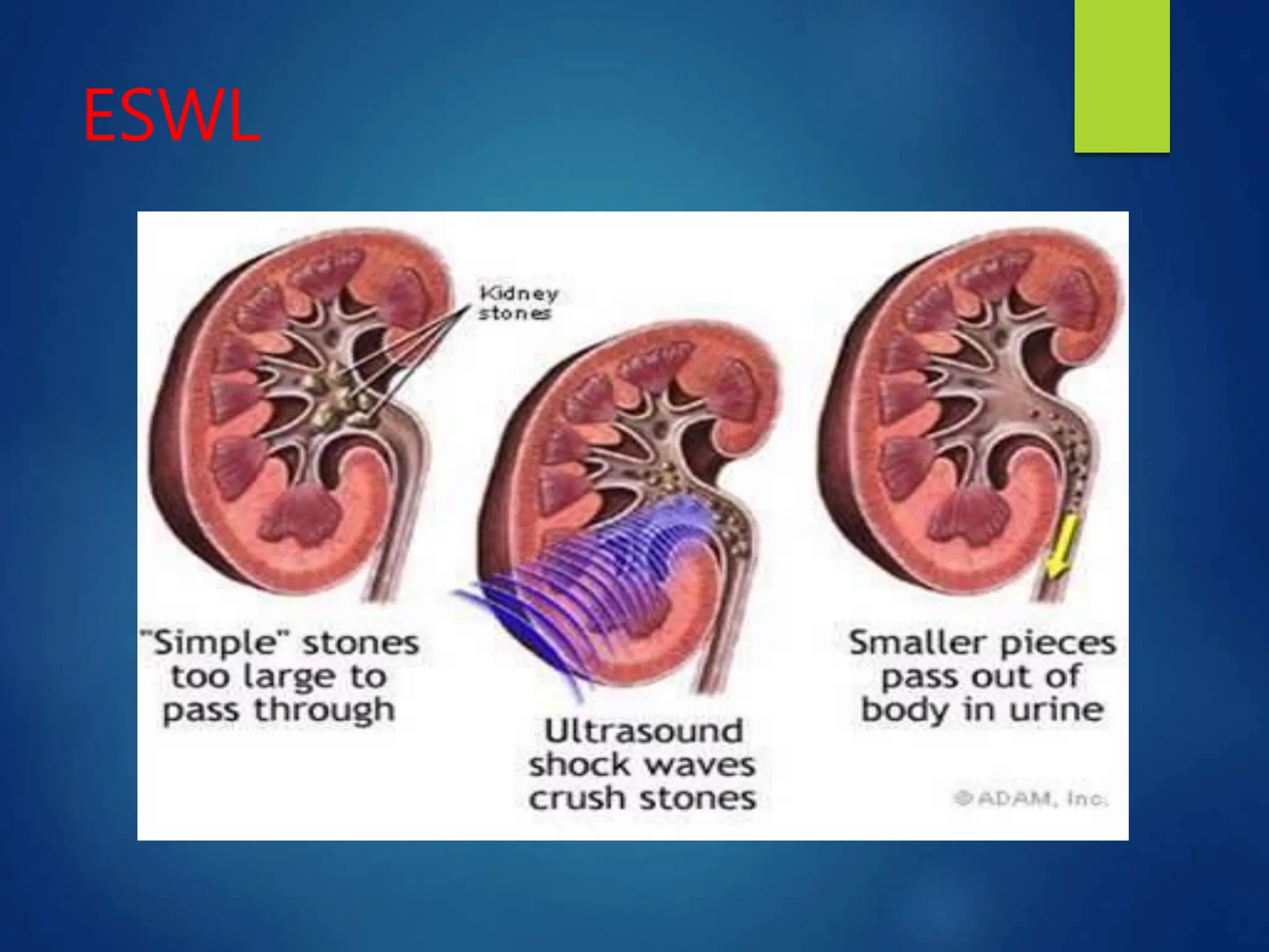 urolithiasis 2 by Dr Ahmed Sajjad HIT Taxila | PPT