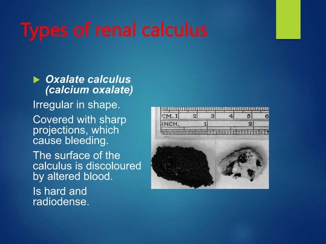 urolithiasis 2 by Dr Ahmed Sajjad HIT Taxila | PPT