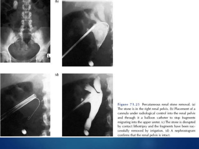 urolithiasis 2 by Dr Ahmed Sajjad HIT Taxila | PPT