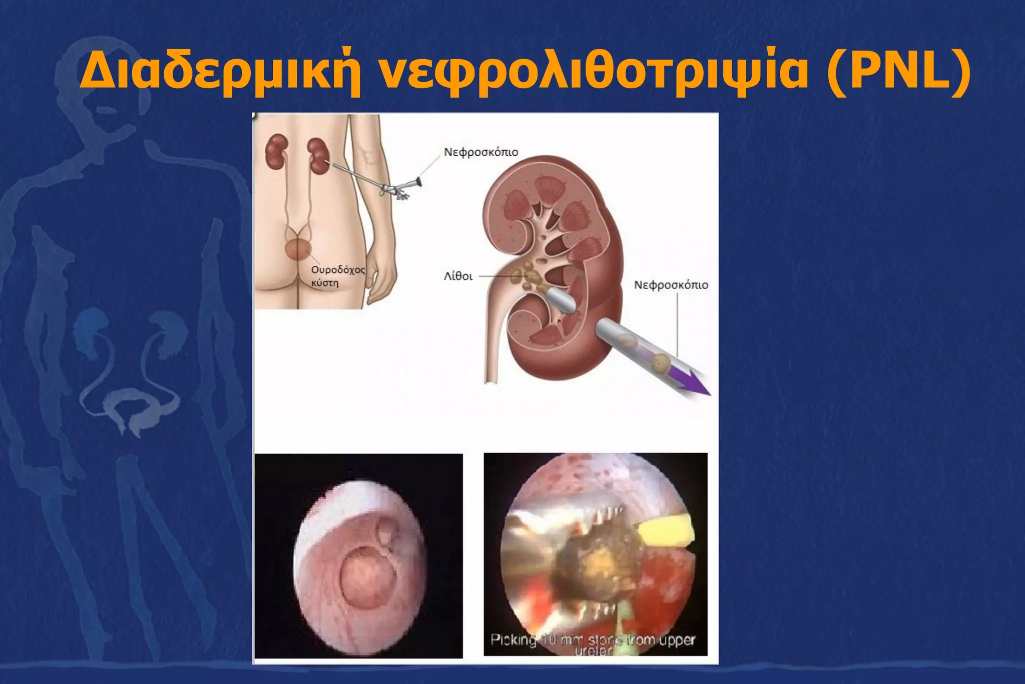 Urolithiasis 2019 | PPT
