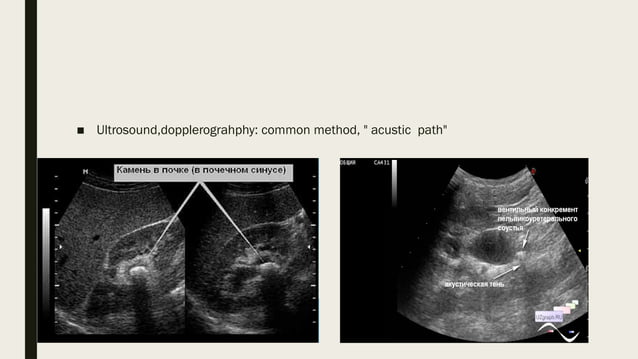 Urolithiasis in children, urinary tract stone disease.pptx