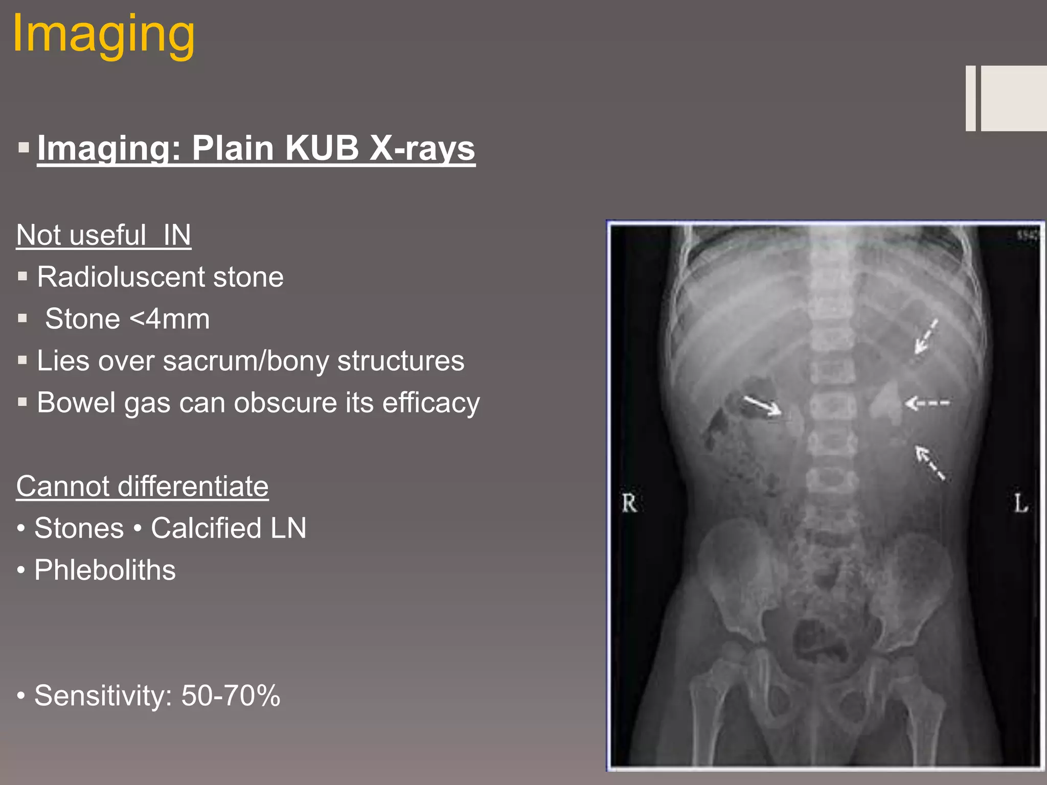 Urolithiasis pathophysiology , medical management | PPTX