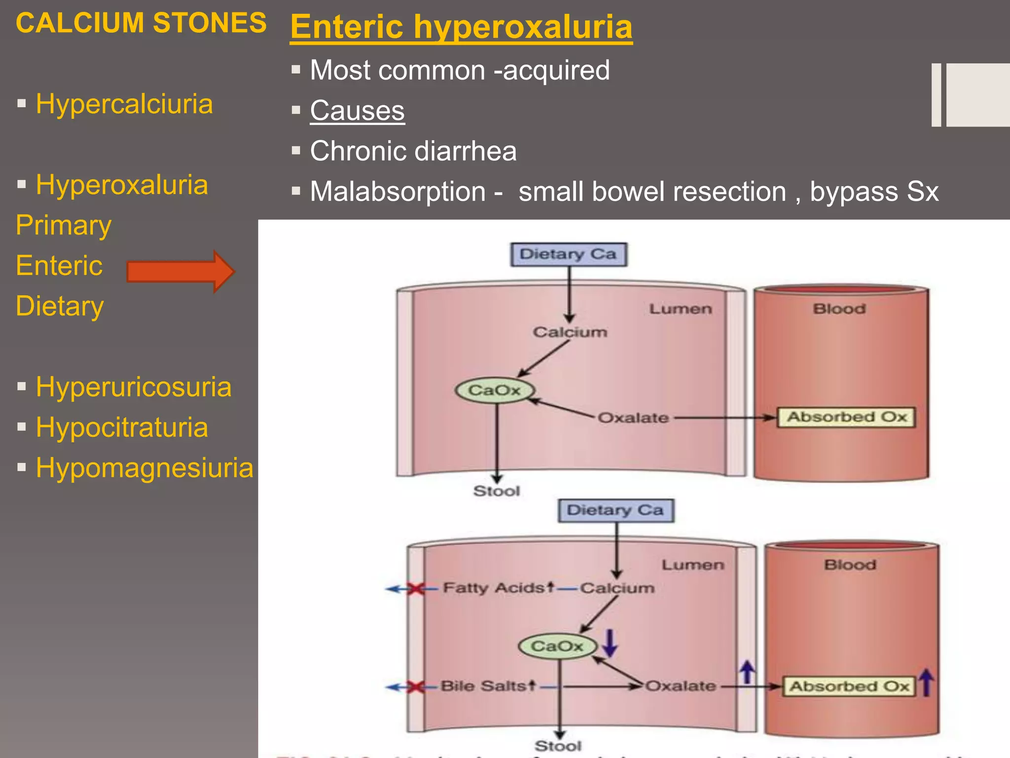 Urolithiasis pathophysiology , medical management | PPTX