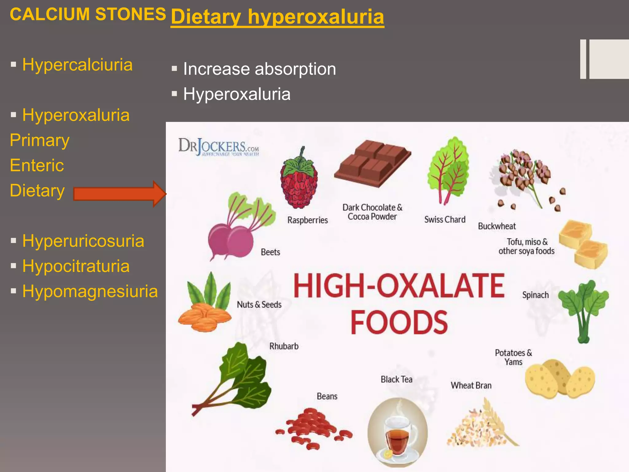 Urolithiasis pathophysiology , medical management | PPTX